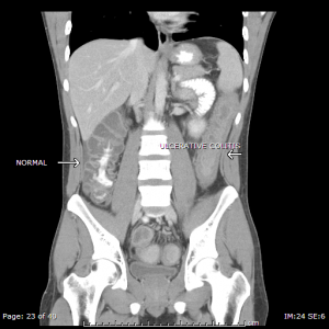 Ulcerative colitis - Gastroparesisclinic.org